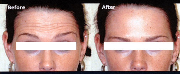 Frown Lines / Sharper Chin etc. Facial Aesthetics Malaysia | Dentist ...