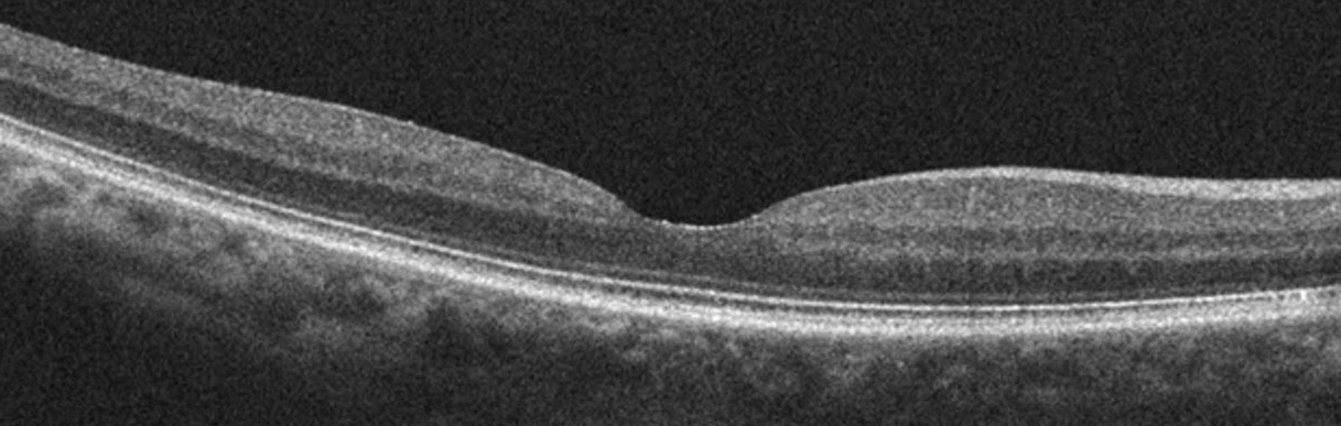 Normal macula - Discovery Eye Foundation