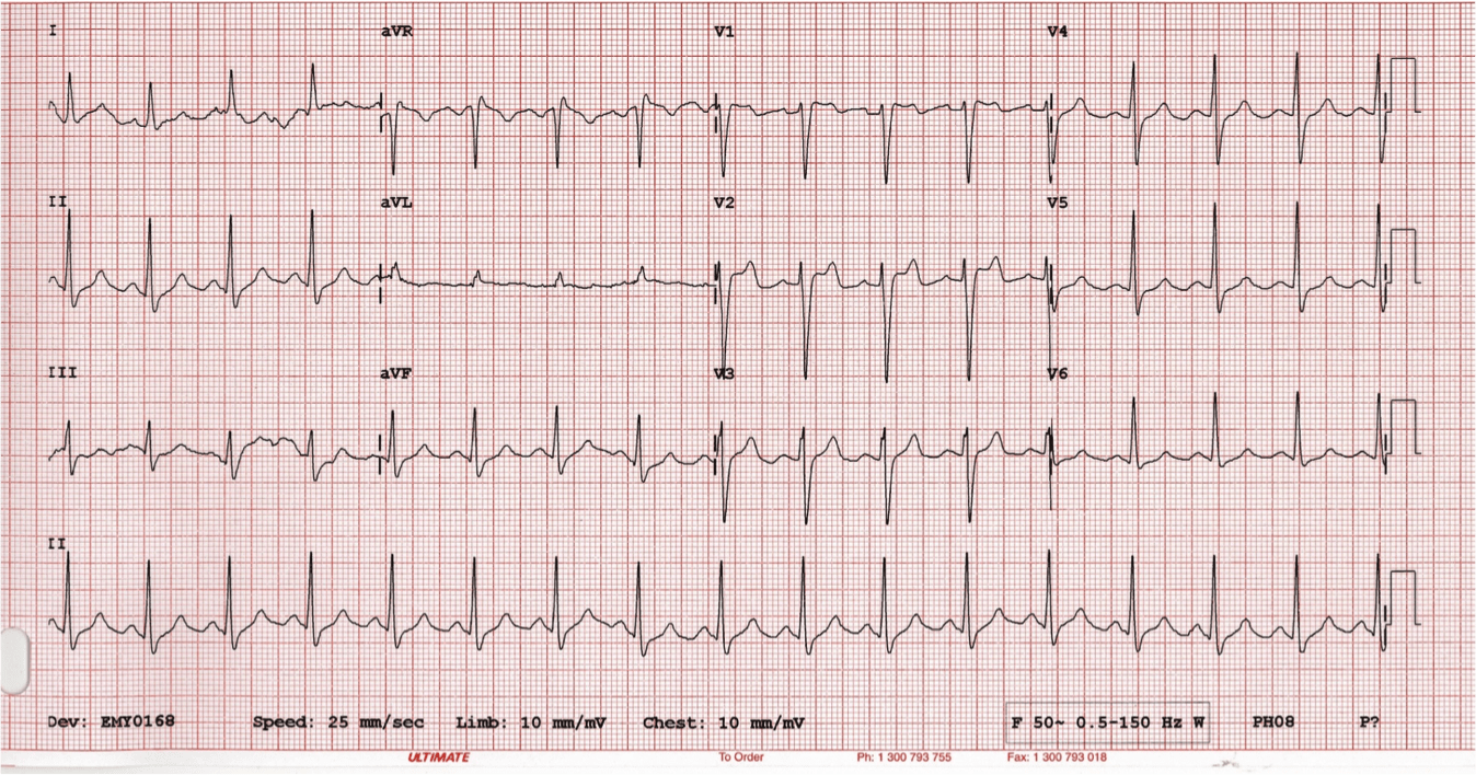 Syncope ECGs