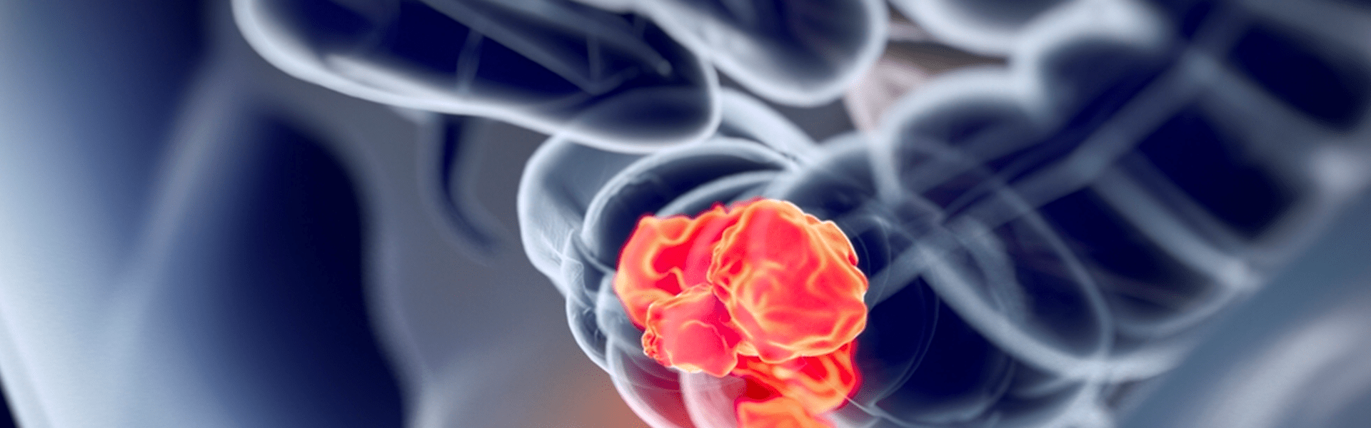 Câncer de Cólon: Causas, Sintomas e Tratamentos - Especialista em ...