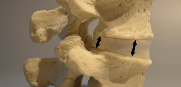 Intradiscal pressure and height – Dynamic Disc Designs