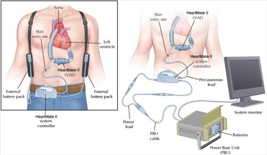 LVAD Problems and Troubleshooting - ED ECMO