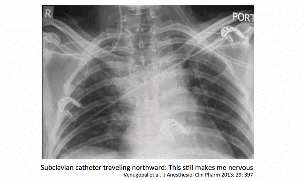 Left Axillary Artery