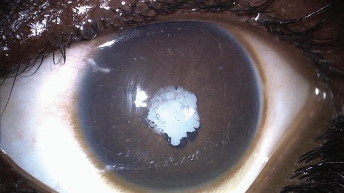 Etiology and Morphology of Pediatric Cataracts | Ento Key