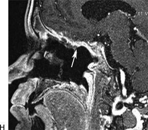 Nonvascularized Repair of Large Dural Defects | Ento Key