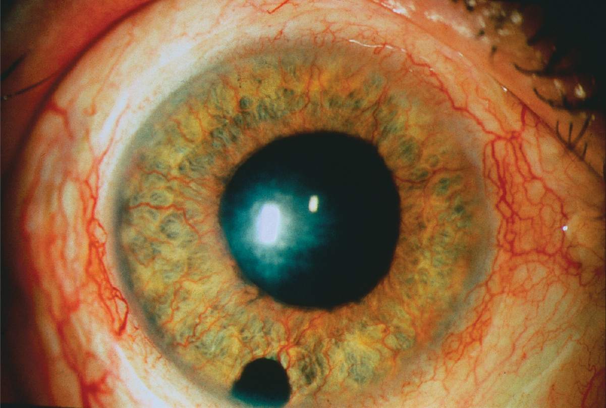 9: Glaucoma | Ento Key