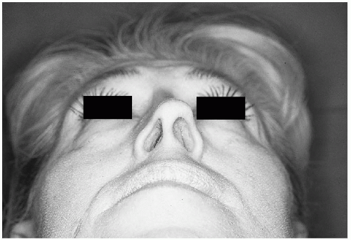 Nasal Obstruction, Congestion, and Drainage | Ento Key