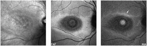 Lipofuscin: The “Wear and Tear” Pigment | Ento Key