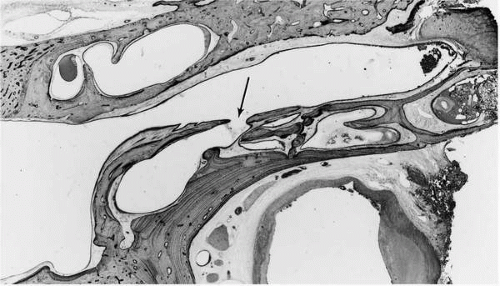 Osteoradionecrosis of the Temporal Bone | Ento Key