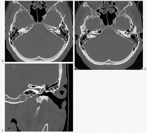 Imaging of the Temporal Bone | Ento Key