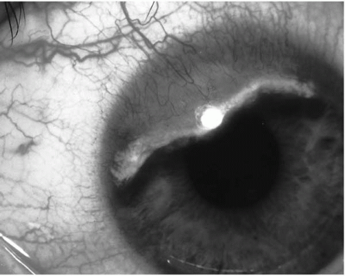 Corneal and Conjunctival Degenerations | Ento Key