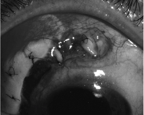 Scleral Transplantation | Ento Key