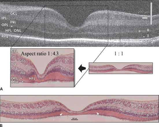 7 Foveal Development and Photoreceptor Development | Ento Key