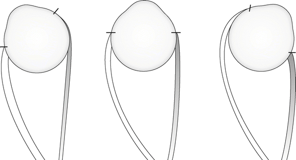 Principles of Strabismus Surgery | Ento Key
