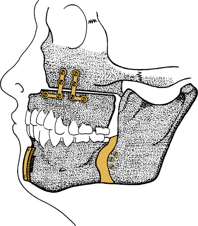 Otology and Neurotology | Ento Key