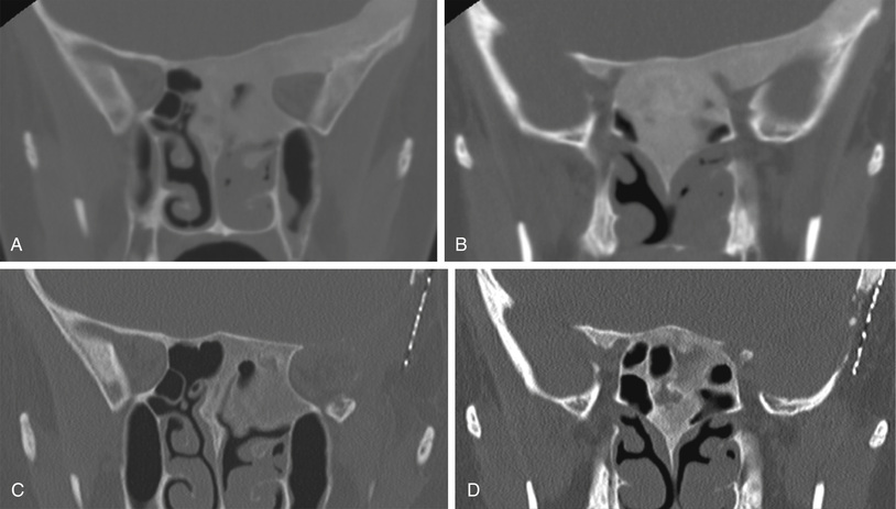 Orbital Bone Tumors | Ento Key