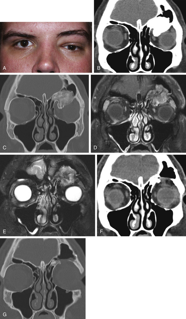 Orbital Bone Tumors | Ento Key