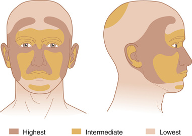 Malignant Tumors of the Eyelid | Ento Key