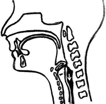 Presbyphagia | Ento Key