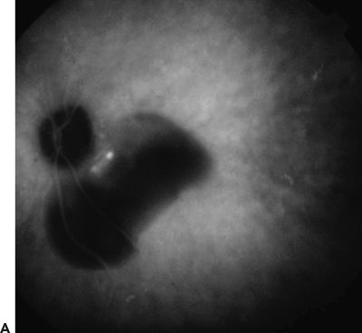 Polypoidal Choroidal Vasculopathy | Ento Key