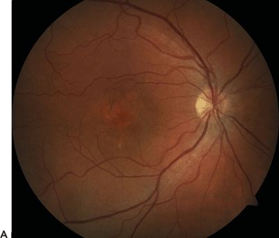 Differential Diagnosis of Age-Related Macular Degeneration | Ento Key