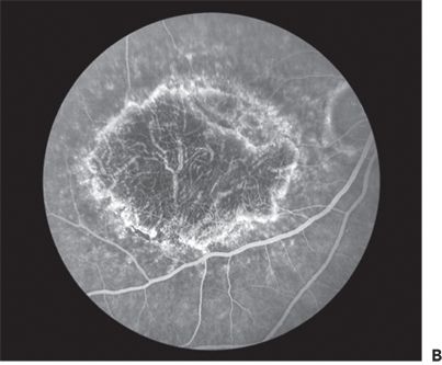 Differential Diagnosis of Age-Related Macular Degeneration | Ento Key