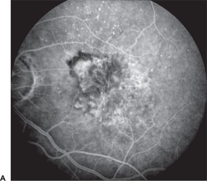 Fluorescein Angiography | Ento Key