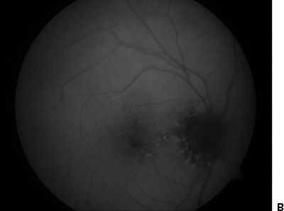 Fundus Autofluorescence Imaging in Age-Related Macular Degeneration ...