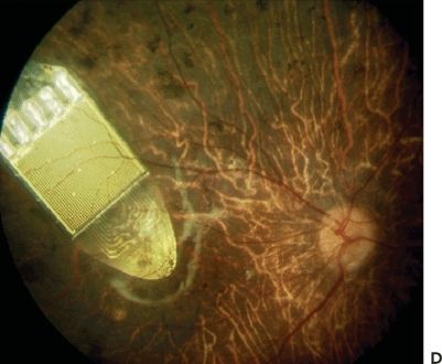 Artificial Vision, Retinal Implants, and Implantable Telescope | Ento Key