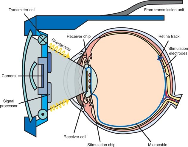 Artificial Vision, Retinal Implants, and Implantable Telescope | Ento Key