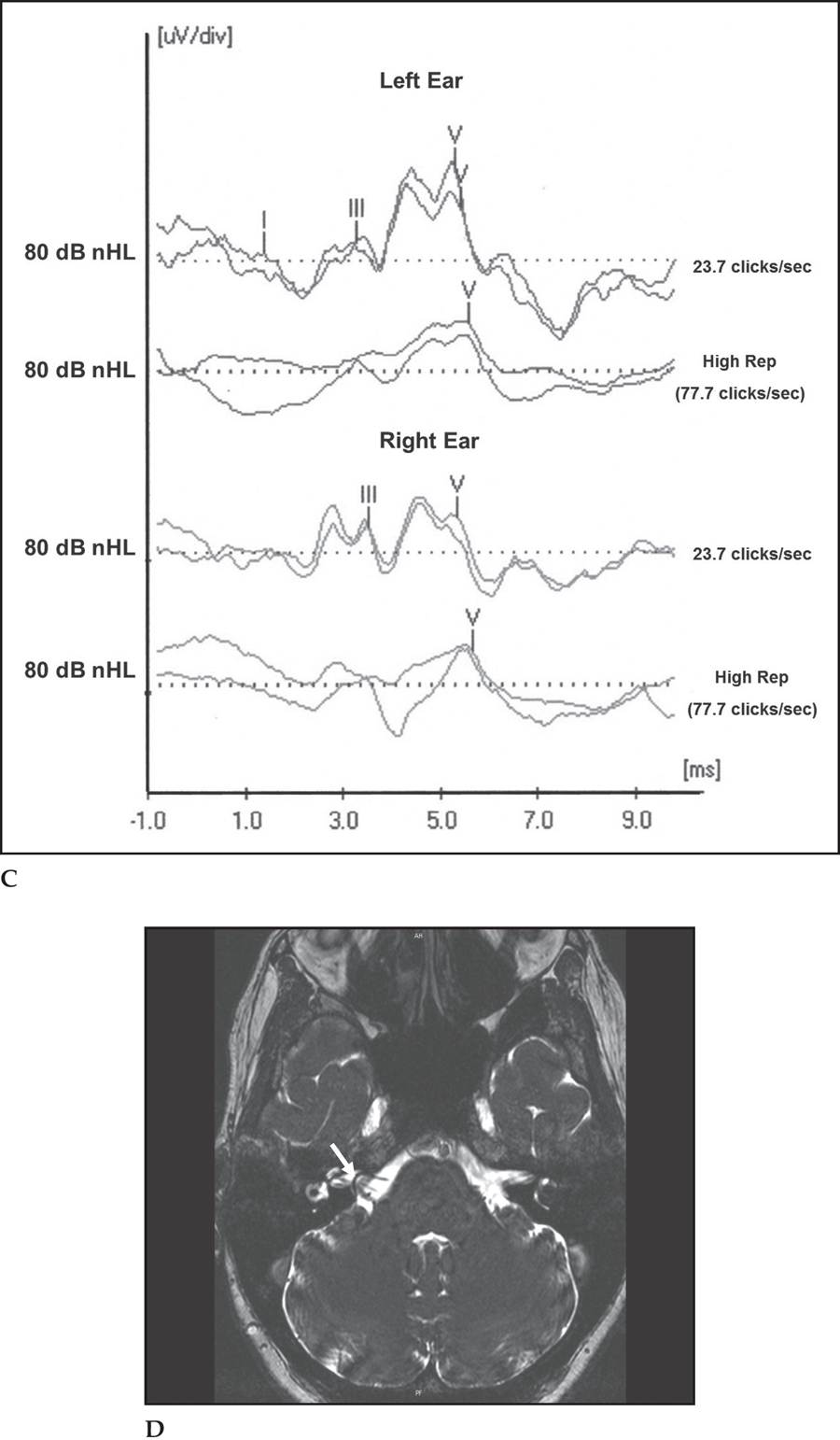 Auditory Nerve Disorders | Ento Key