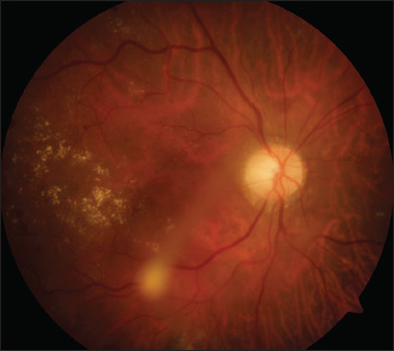 The Retina | Ento Key
