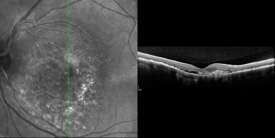 Choroidal Osteoma | EYE-PIX