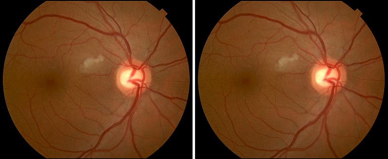 Color Fundus Photography | EYE-PIX