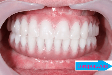 Full Dentures That Look Real – Natural, Beautiful and Comfortable - For ...