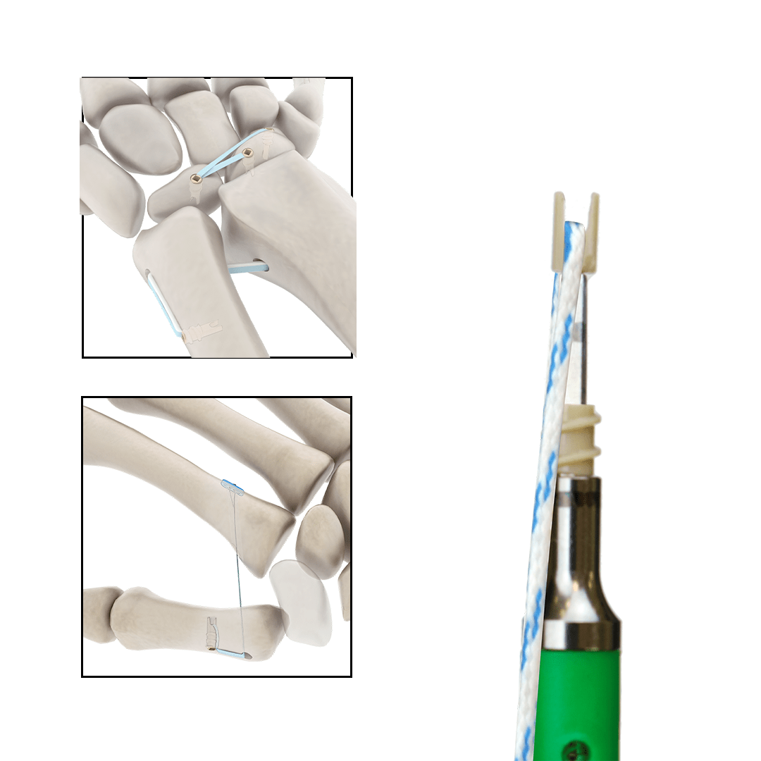 FASTLOCK - ÂNCORAS EM PEEK - GMReis