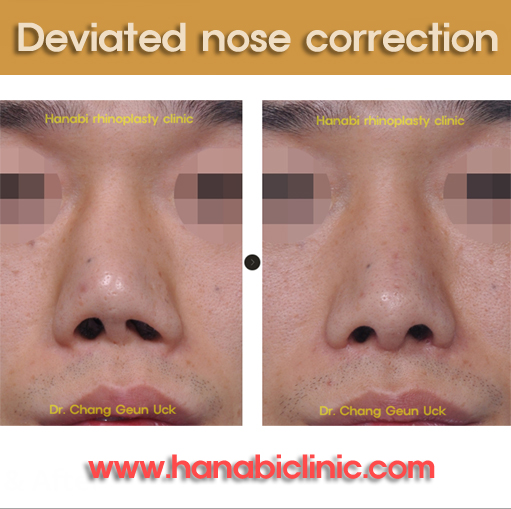 deviated nasal septum surgery and rhinoplasty - HANABI RHINOPLASTY CLINIC