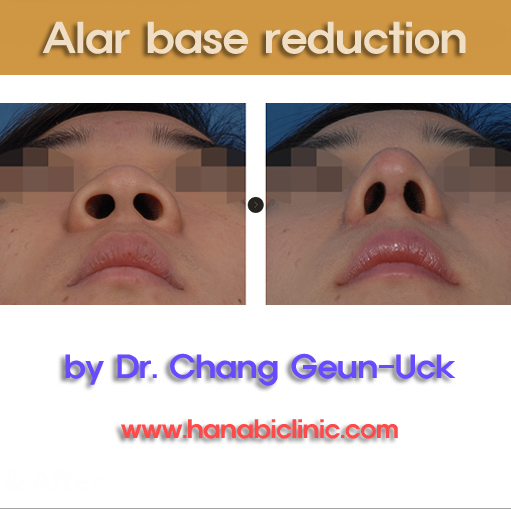 alar base reduction - HANABI RHINOPLASTY CLINIC