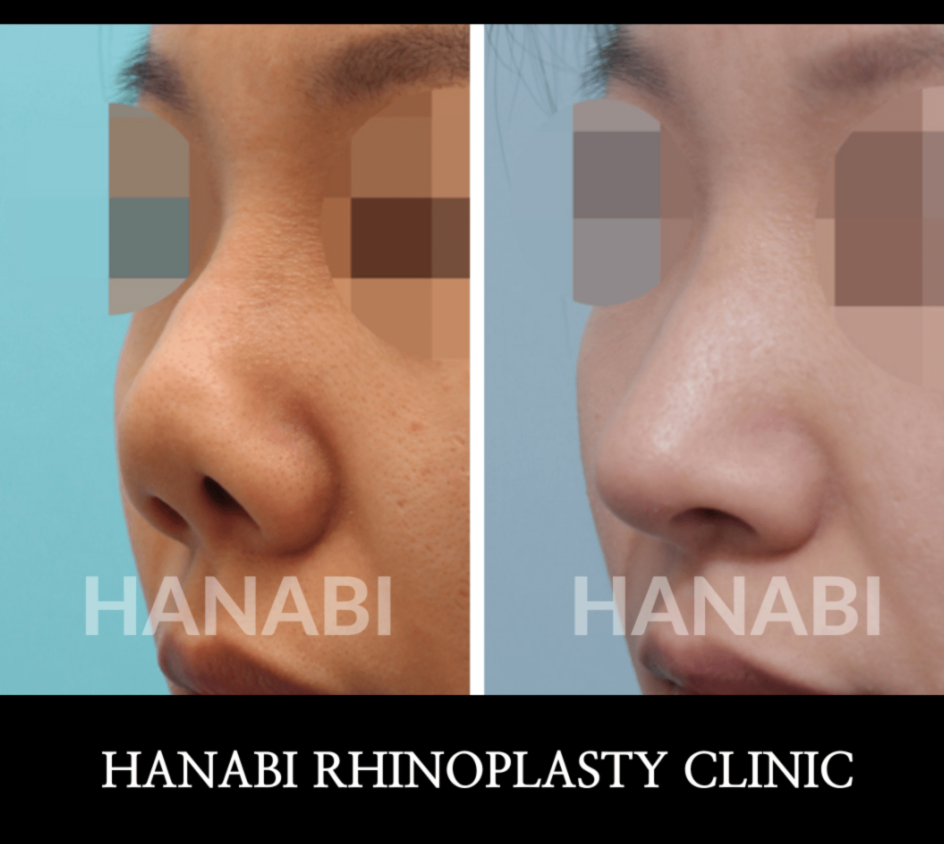 contracted nose - HANABI RHINOPLASTY CLINIC