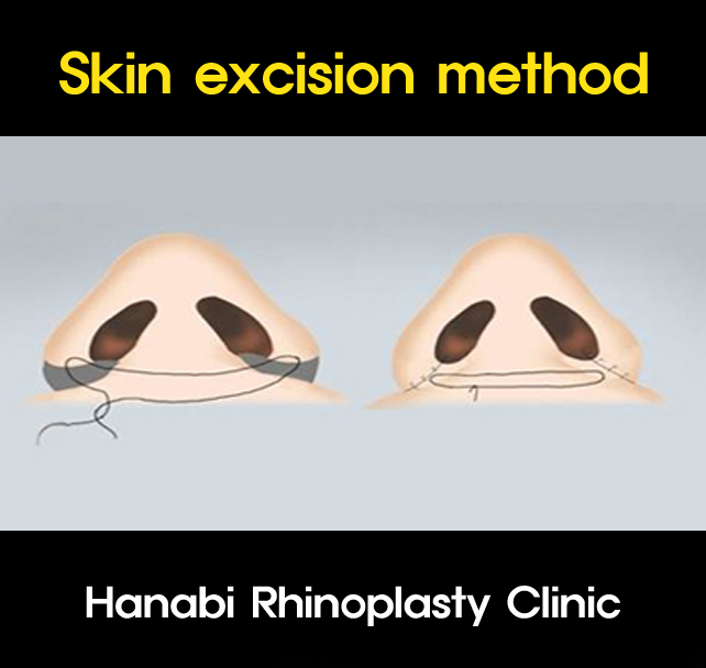 Alar base reduction surgery - HANABI RHINOPLASTY CLINIC