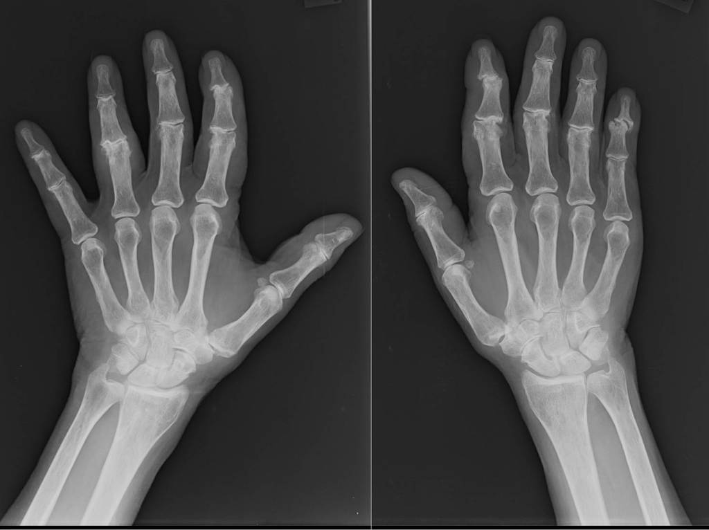 A Patient's Guide to Osteoarthritis of the Hand - Hand and Upper Limb ...