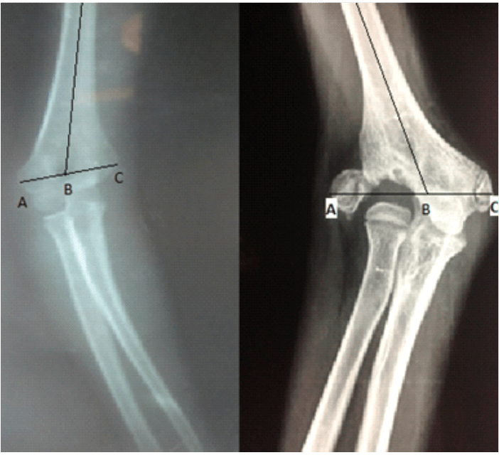 Clinical and Radiological Outcome following Kim's Step cut Translation ...