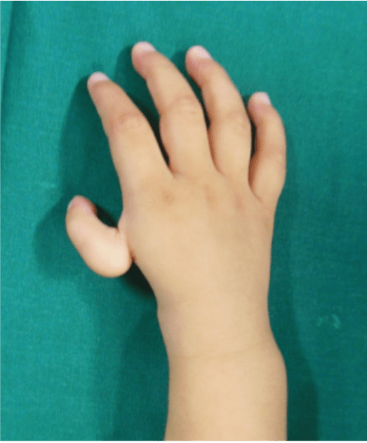 Pollicisation: Embryology, History, Technique and Results ...