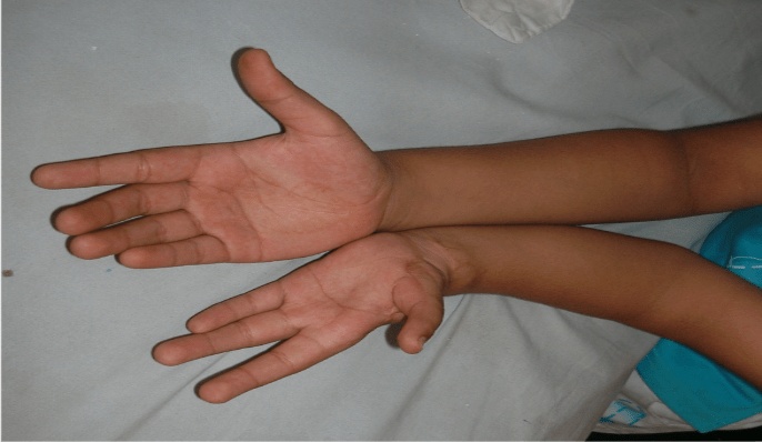 Pollicisation: Embryology, History, Technique and Results ...