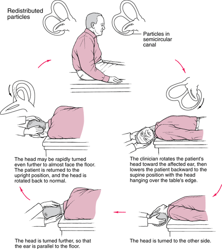 BPPV: Benign Paroxsmal Positional Vertigo | Kinney Physical Therapy