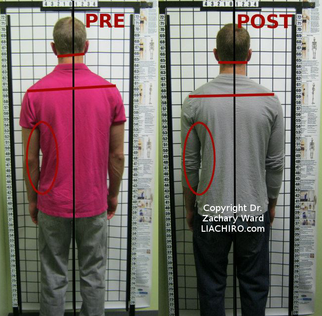 The #1 secret to lasting sciatica pain relief – with pictures