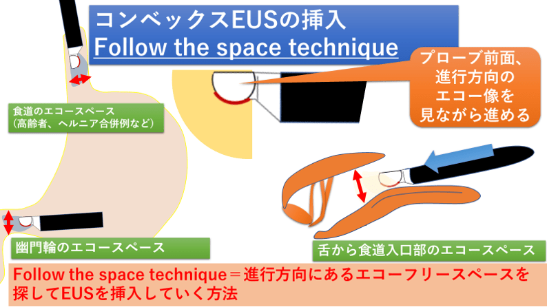 EUSを安全に実施するコツ | EUS channel