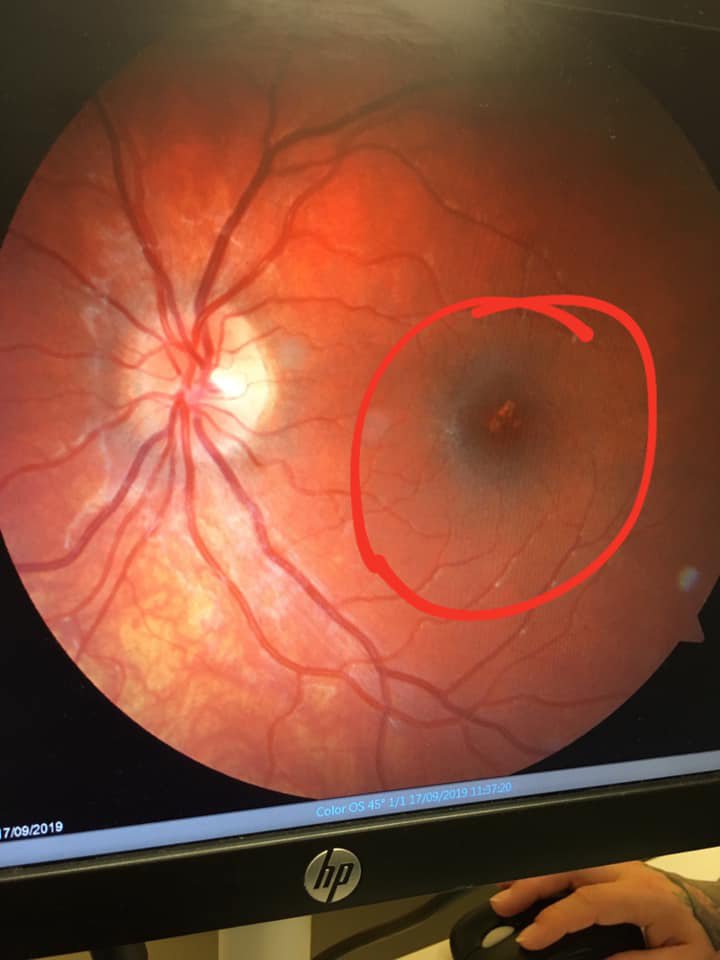 Boy nearly loses eyesight and left with permanent scar from laser pen ...