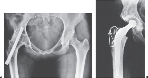 Conversion of Hip Arthrodesis to Total Hip Arthroplasty ...