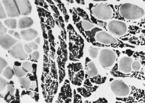 Disorders of the Anterior Horn Cell | Musculoskeletal Key